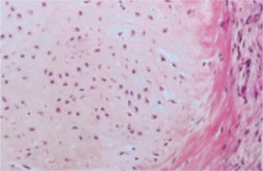 Encondromatosis Múltiple familiar - Dr. Santos Rodas
