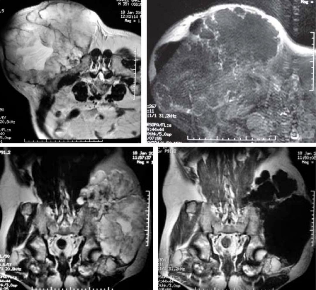 Encondromatosis Múltiple Familiar CIRUGIA SARCOMAS SURGERY SARCOMA ...